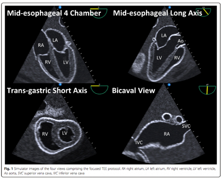 Look Deep Inside Yourself: Echo in Cardiac Arrest - EMOttawa Blog