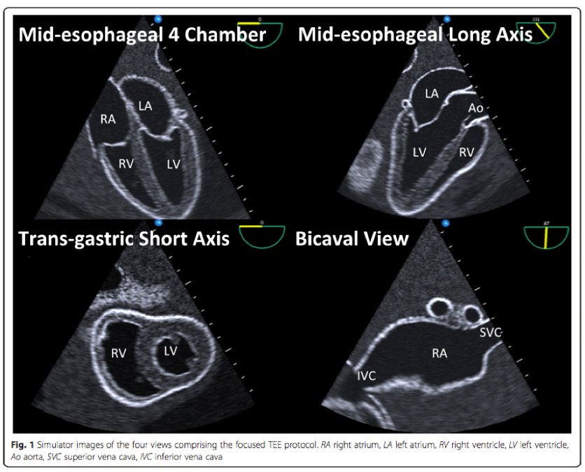 Look Deep Inside Yourself: Echo in Cardiac Arrest - EMOttawa Blog