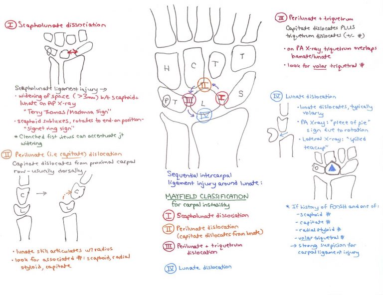Scapholunate instability (the Mayfield Classification) - EMOttawa Blog