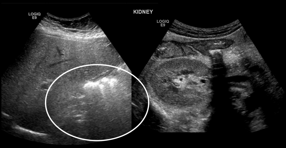 Focus on POCUS: Crackles and Hypotension - EMOttawa Blog