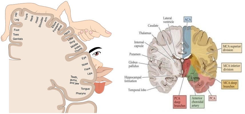 Identifying stroke mimics in the ED - EMOttawa Blog