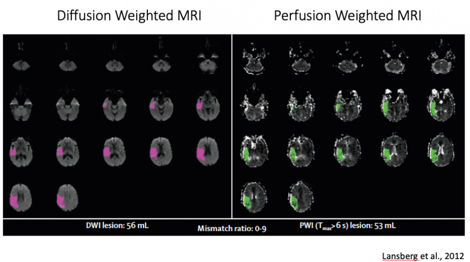 An Update on the ED Management of Acute Ischemic Stroke and TIA