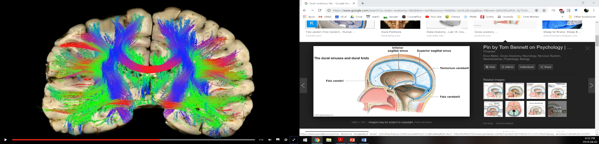 Concussion: Inside the Head (Part 1) - EMOttawa Grand Round Summaries