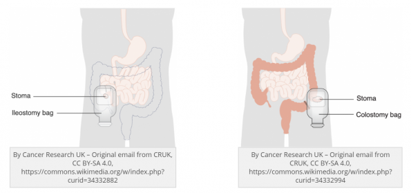 Ostomy Issues: Common Presentations in the Emergency Department ...