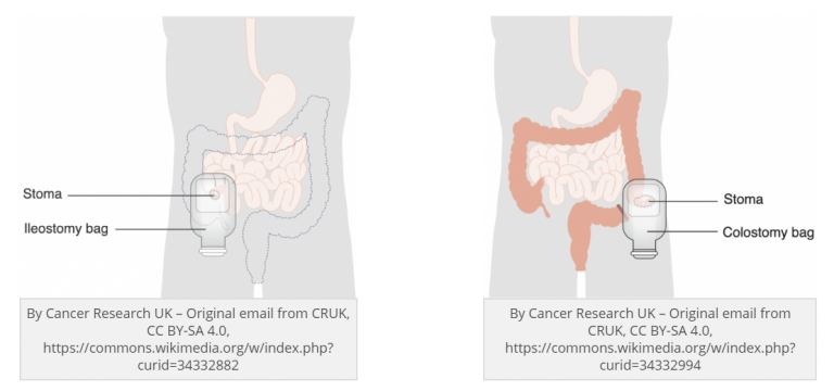 Ostomy Issues: Common Presentations in the Emergency Department ...