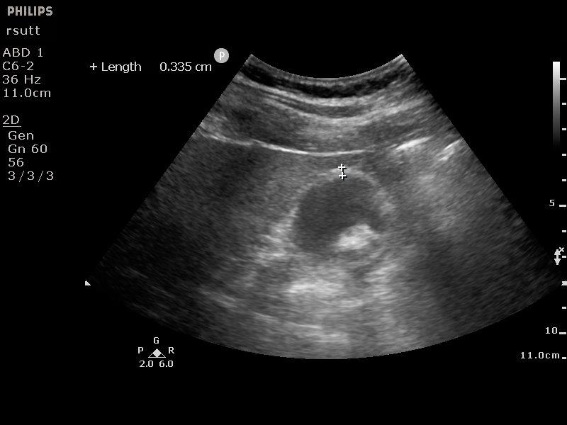 Gallbladder Case 6 - EMOttawa Blog