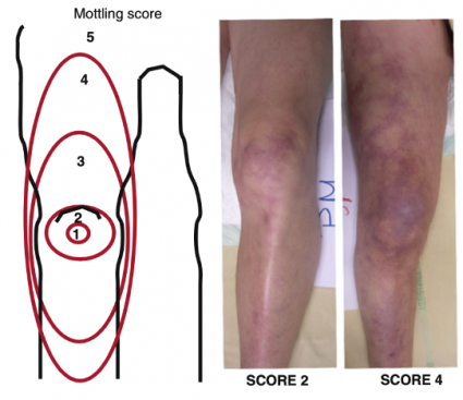 Sepsis and Septic Shock - EMOttawa