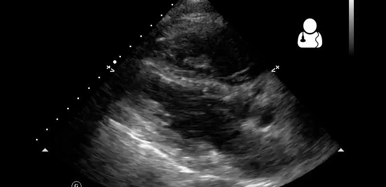 Increased Sensitivity of Focused Cardiac Ultrasound for Pulmonary ...