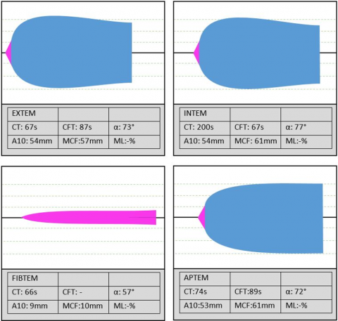ROTEM in Trauma: Blood is thicker with Wine - Part 2 - EMOttawa Blog