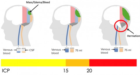 Breaking the Brain Code: Elevated ICP in the ED Part I - EMOttawa Blog