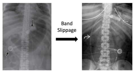 Bariatric Surgery Complications in the ED - EMOttawa Blog