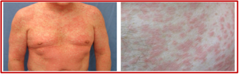 Drug Rashes - EMOttawa Blog