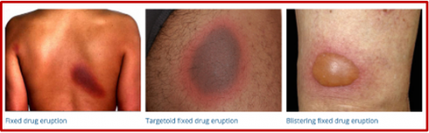 Drug Rashes - EMOttawa Blog