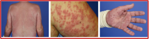 Drug Rashes - EMOttawa Blog
