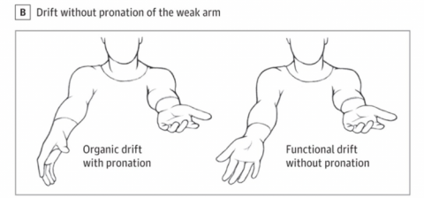 Functional Neurologic Disorders - EMOttawa Blog