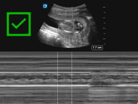 PoCUS Pearl - Measuring Fetal Heart Rate - EMOttawa Blog