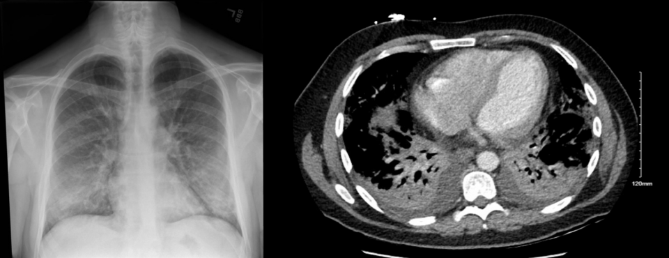 Inhalation Injuries: The Answers You’ve Been LUNGing For - EMOttawa Blog