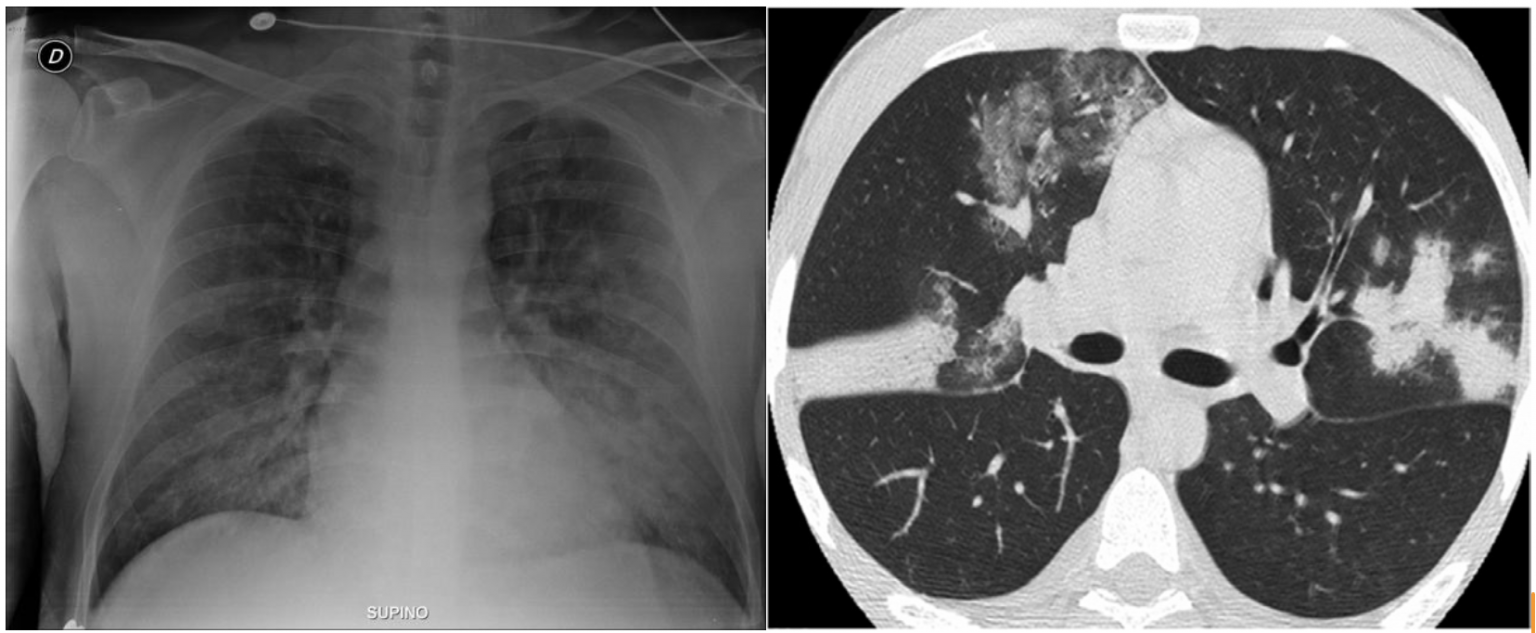 Inhalation Injuries: The Answers You’ve Been LUNGing For - EMOttawa Blog