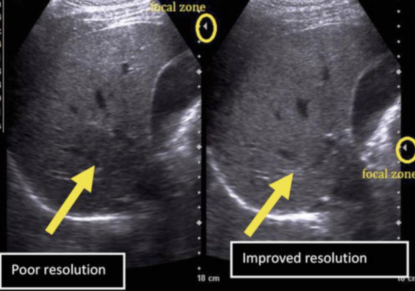 FOCUS your PoCUS! - EMOttawa Blog