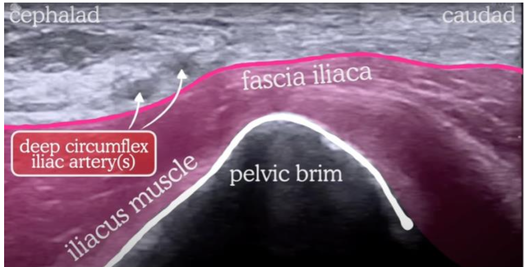 Fascia's Back: The Supra-Inguinal Fascia Iliaca (SIFI) Block - EMOttawa ...