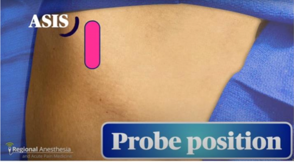 Fascia's Back: The Supra-Inguinal Fascia Iliaca (SIFI) Block - EMOttawa ...