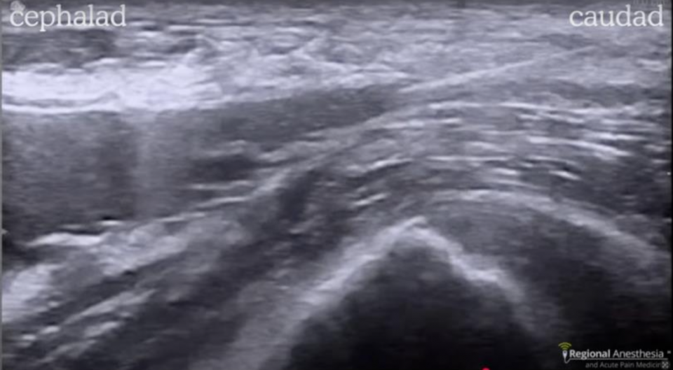 Fascia's Back: The Supra-Inguinal Fascia Iliaca (SIFI) Block - EMOttawa ...